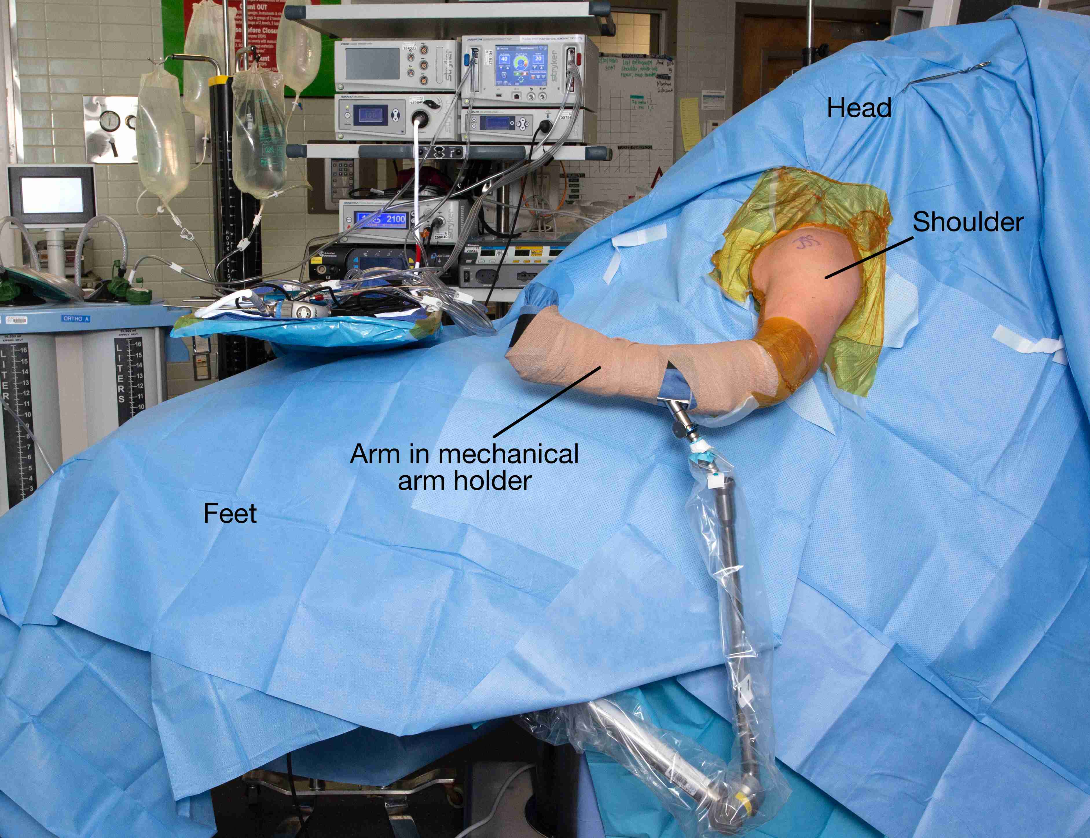 Rotator Cuff Surgery Local Anesthesia Oclakj