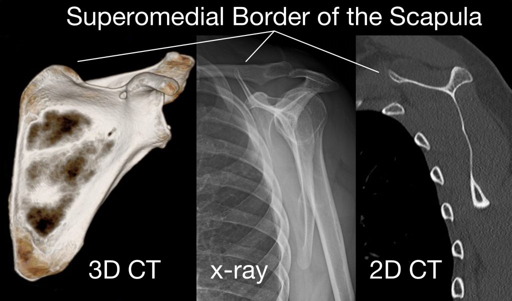 Superomedial border of the scapula - Shoulder & Elbow