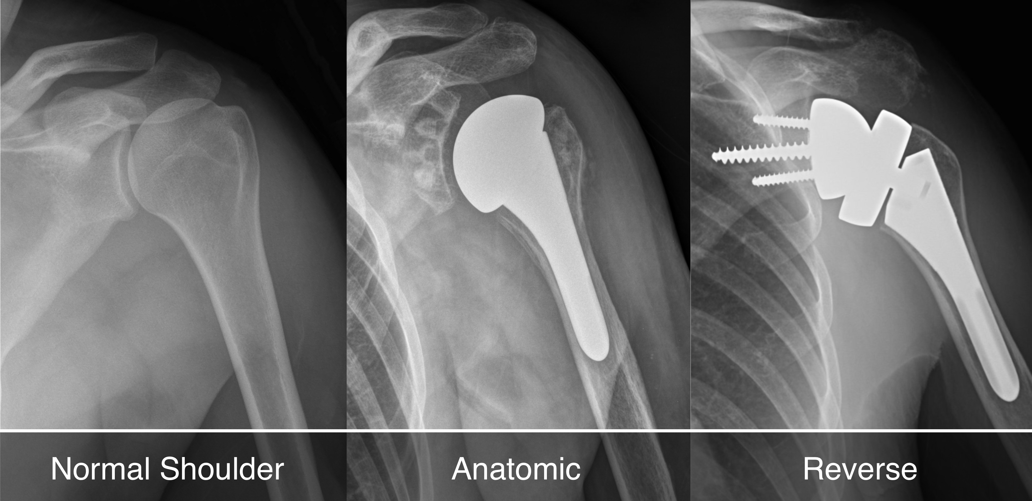 Combined Shoulder Tsa Rsa Shoulder Elbow